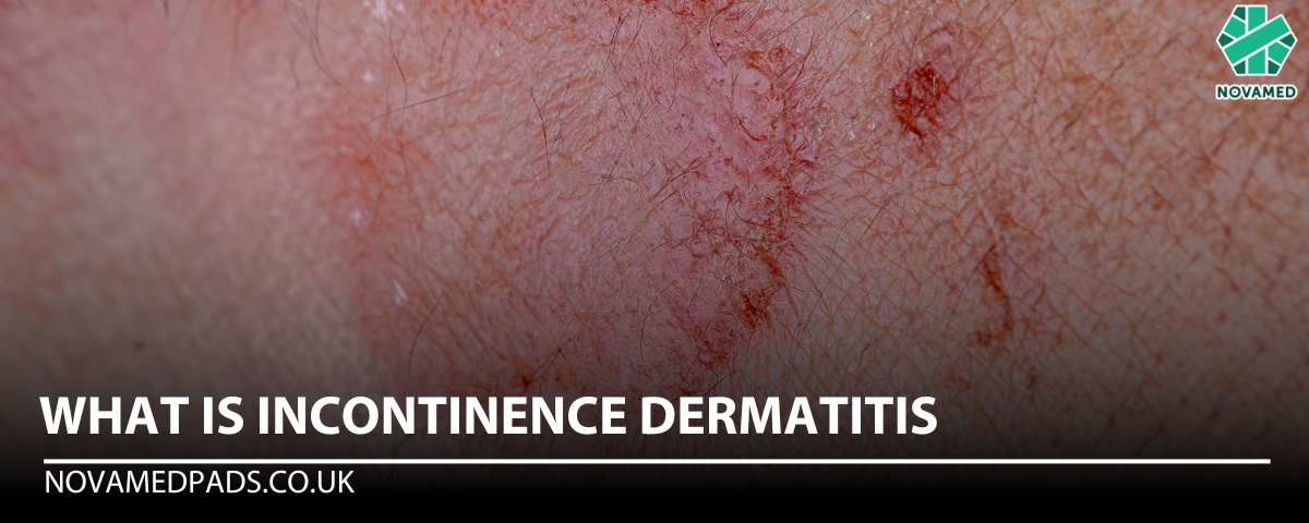 What Is Incontinence Dermatitis | Novamed Pads